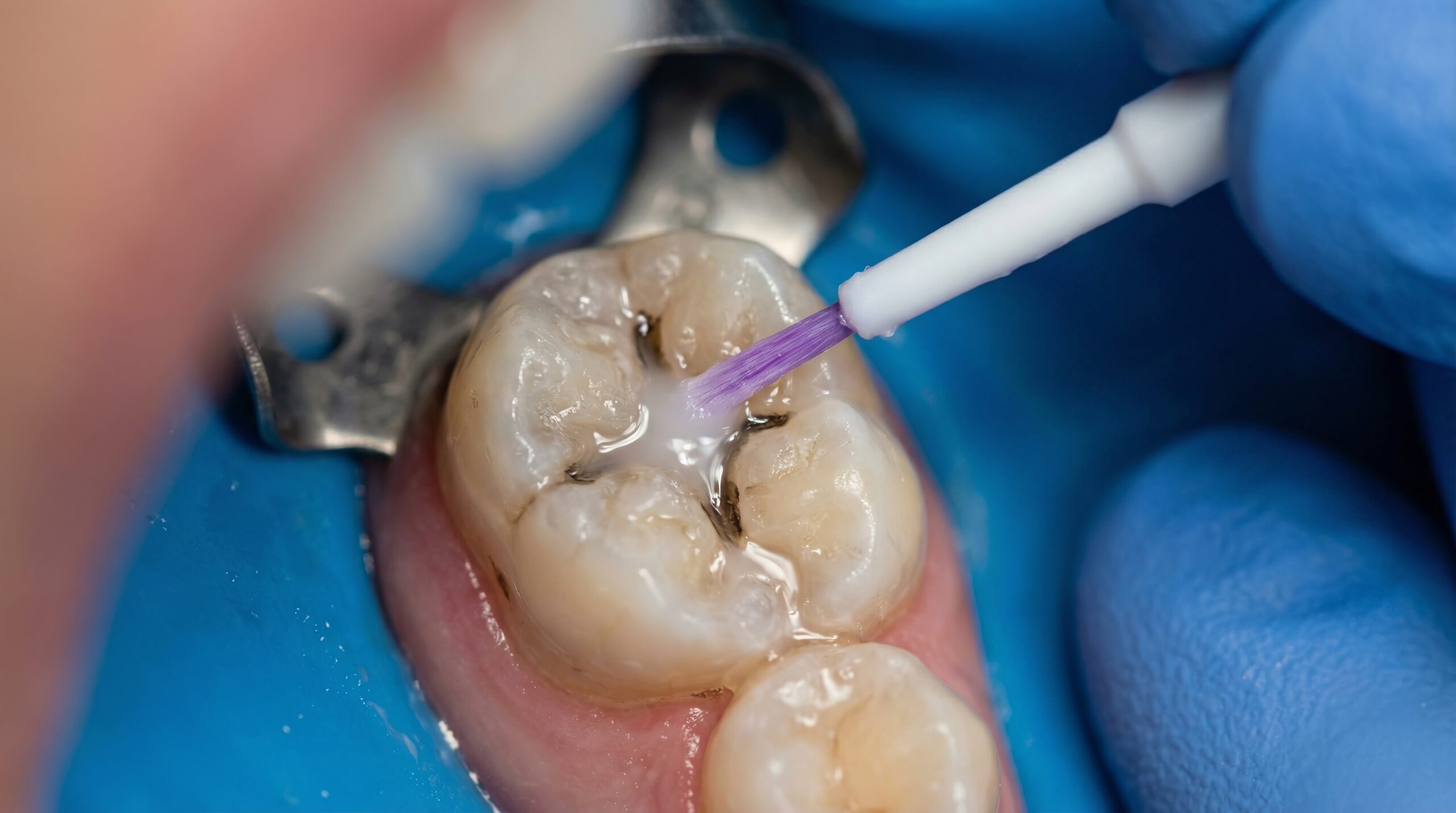 Pit and Fissure Sealants: Benefits and Prevention of Tooth Decay - Dr ...